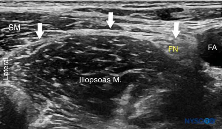 Ultrasound-Guided Fascia Iliaca Nerve Block - NYSORA