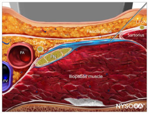Ultrasound-Guided Fascia Iliaca Nerve Block - NYSORA