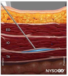 Ultraschallgeführte Nervenblockaden der Transversus-Abdominis-Ebene und ...
