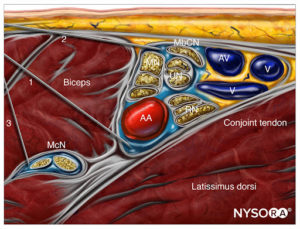 Bloc du plexus brachial axillaire guidé par ultrasons - NYSORA