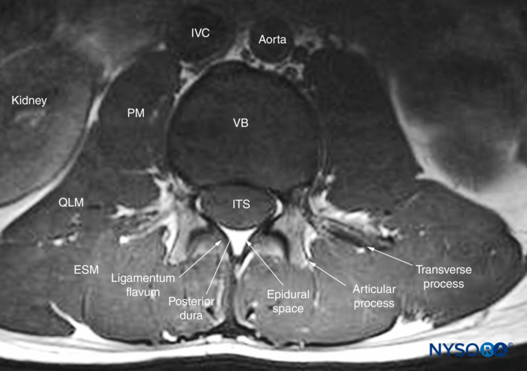 Spinal Sonography and Applications of Ultrasound for Central Neuraxial ...