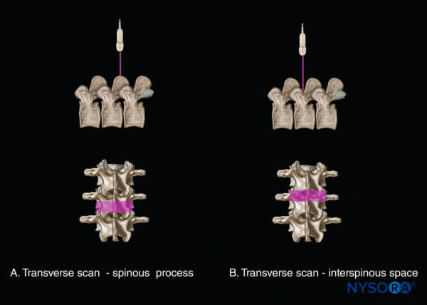 Spinal Sonography and Applications of Ultrasound for Central Neuraxial ...