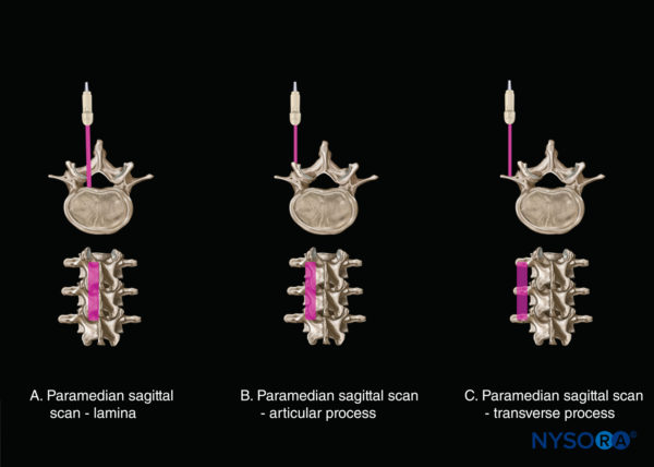 Spinal Sonography and Applications of Ultrasound for Central Neuraxial ...