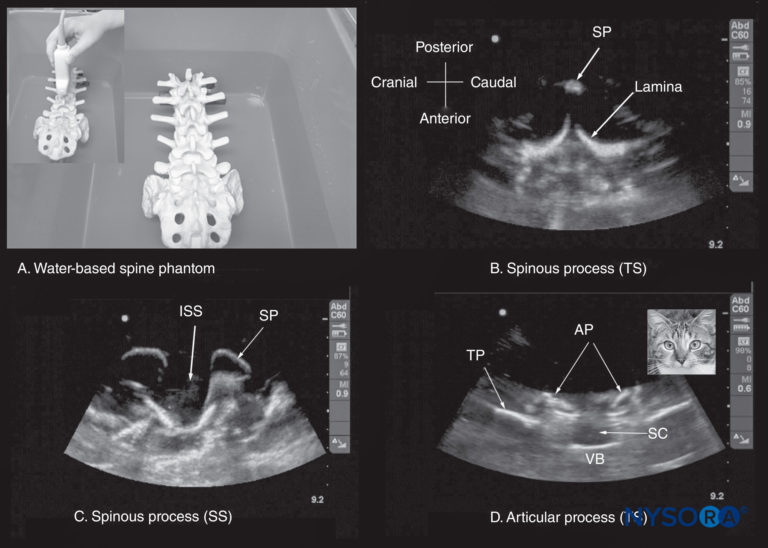Spinal Sonography and Applications of Ultrasound for Central Neuraxial ...