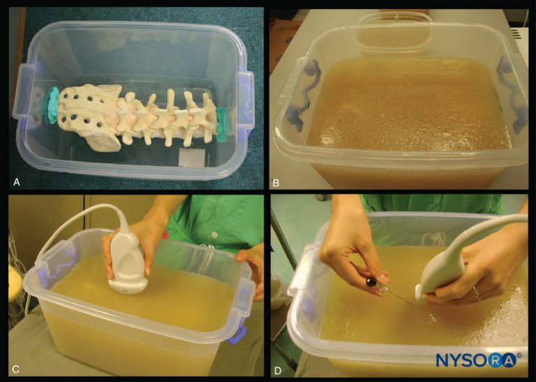 Spinal Sonography and Applications of Ultrasound for Central Neuraxial ...