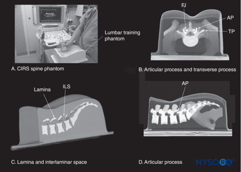 Spinal Sonography and Applications of Ultrasound for Central Neuraxial ...