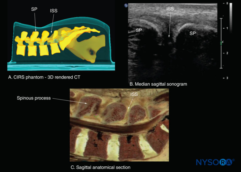 Spinal Sonography and Applications of Ultrasound for Central Neuraxial ...