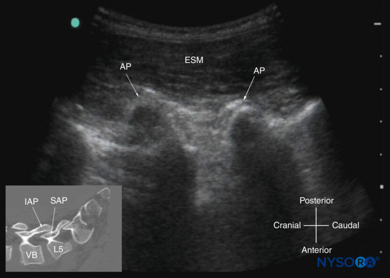 Spinal Sonography and Applications of Ultrasound for Central Neuraxial ...
