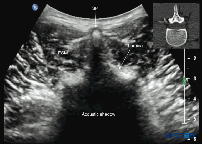 Spinal Sonography and Applications of Ultrasound for Central Neuraxial ...