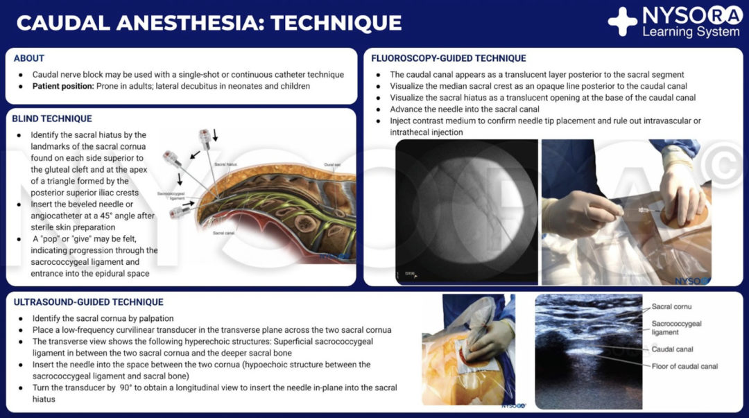 Caudal Anesthesia - NYSORA