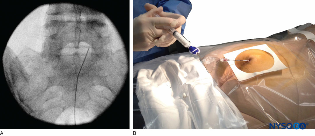 Caudal Anesthesia - NYSORA