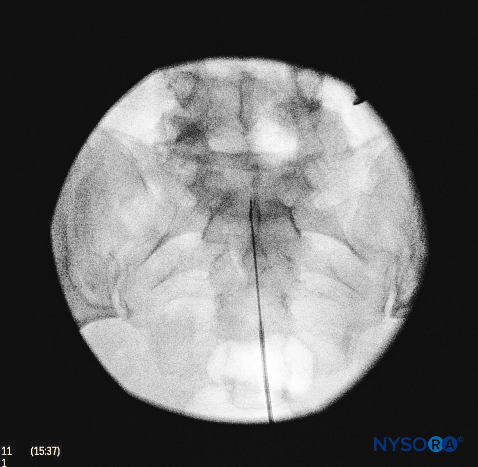 Caudal Anesthesia - NYSORA