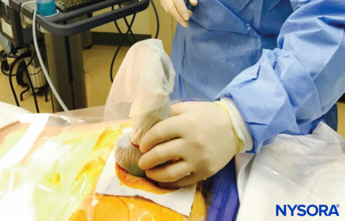 Caudal Anesthesia - NYSORA