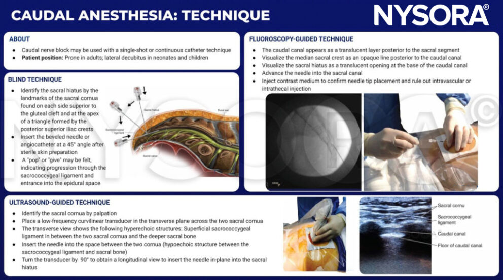 Caudal Anesthesia - NYSORA
