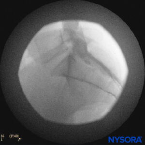 Caudal Anesthesia - NYSORA