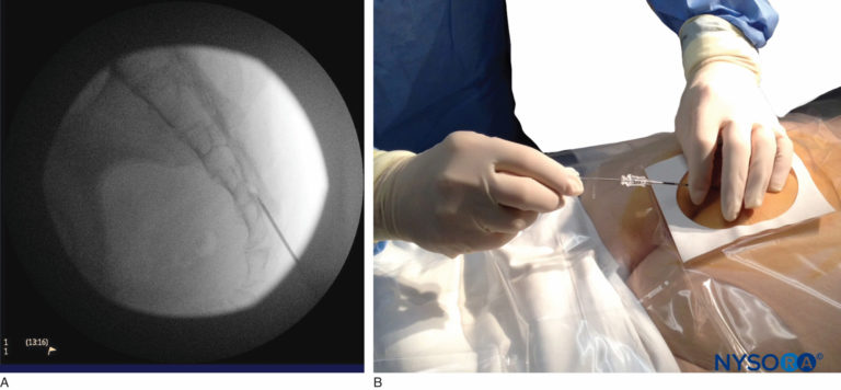 Caudal Anesthesia - NYSORA