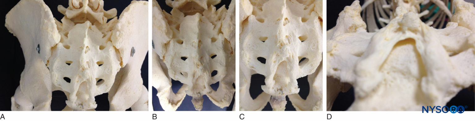 Caudal Anesthesia - NYSORA