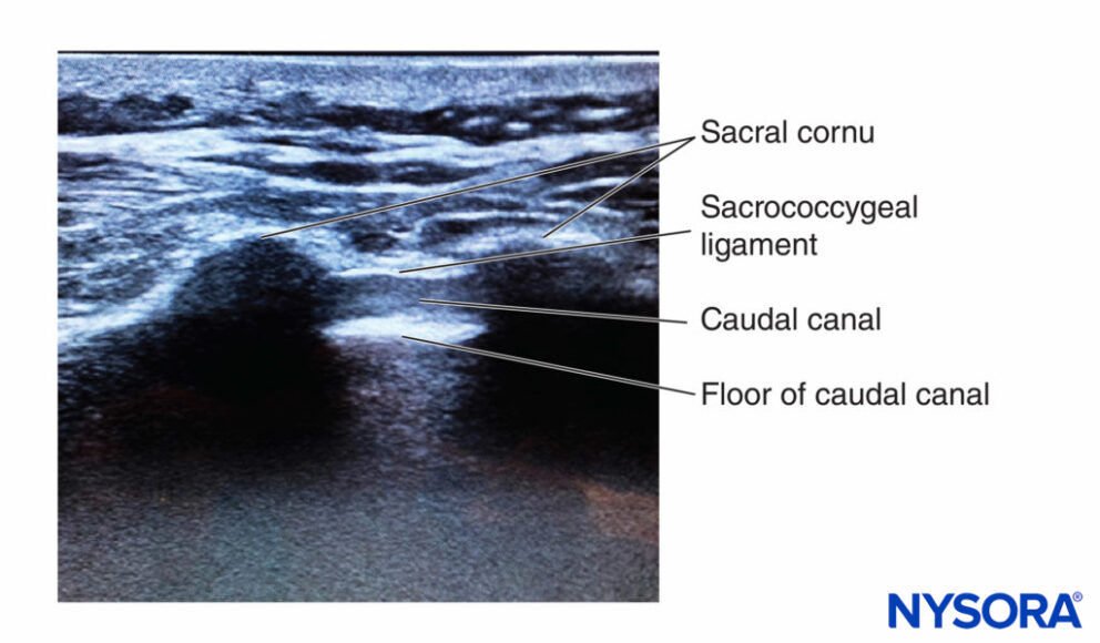 Caudal Anesthesia - NYSORA