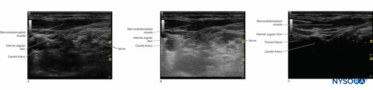 Physics of Ultrasound - NYSORA
