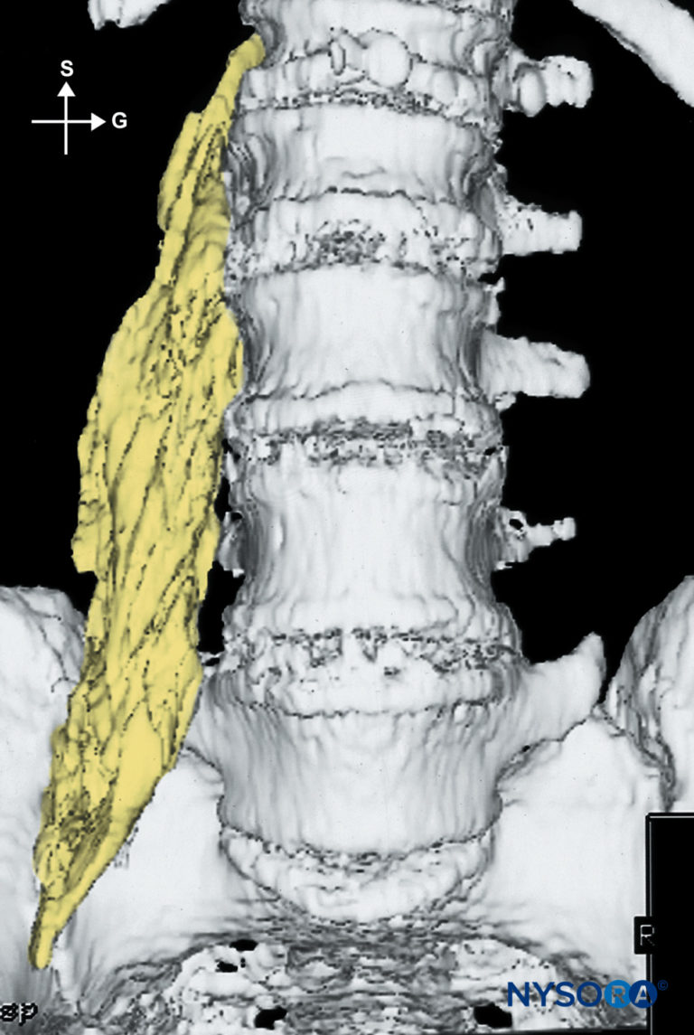 Lumbar Plexus Block - Landmarks and Nerve Stimulator Technique - NYSORA