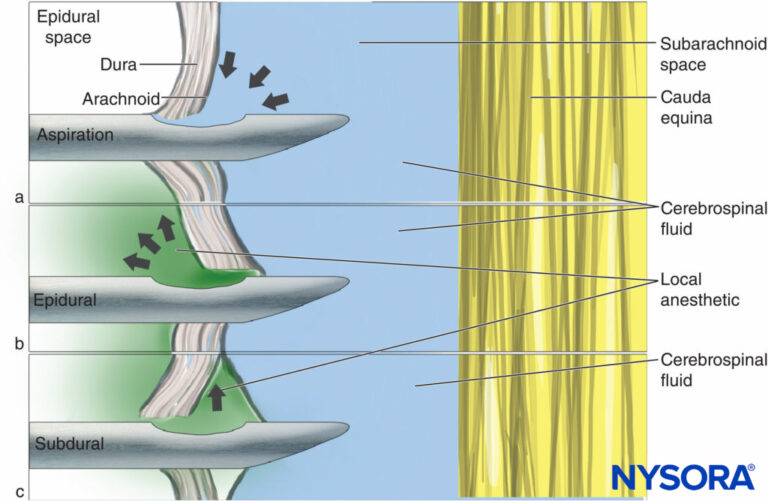 Mechanisms and Management of Failed Spinal Anesthesia - NYSORA