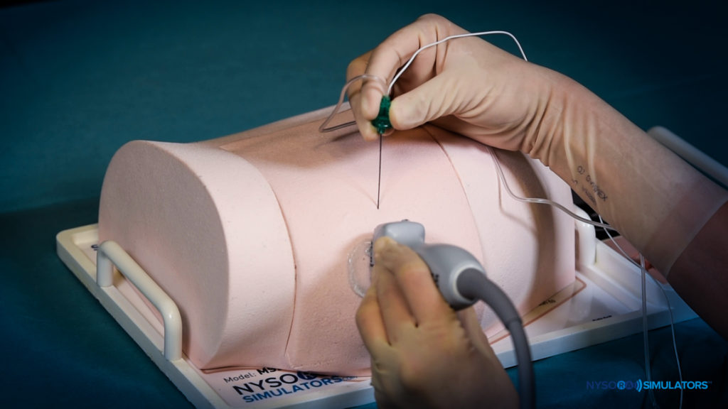 Ipack Block Nysora – Ultrasound-Guided Popliteal Sciatic Nerve Block ...