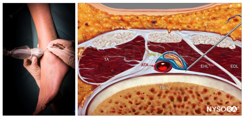 Ultrasound-Guided Ankle Block: NYSORA Web App - NYSORA