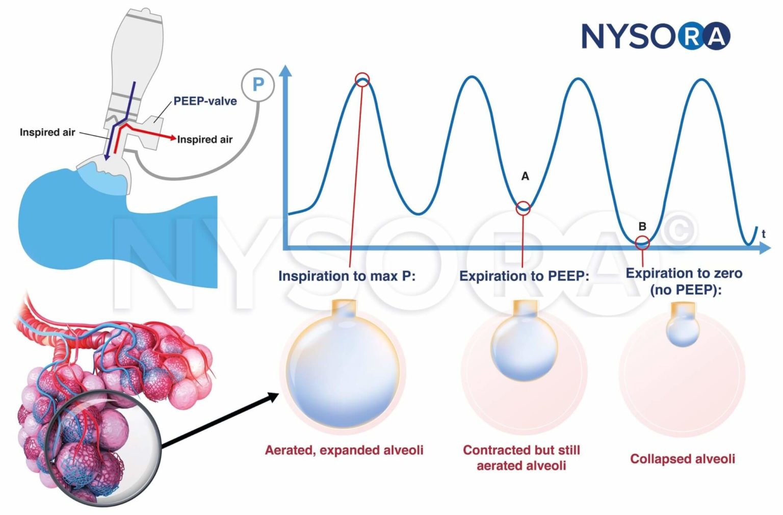 Acute Respiratory Distress Syndrome Management in COVID-19 Patients ...