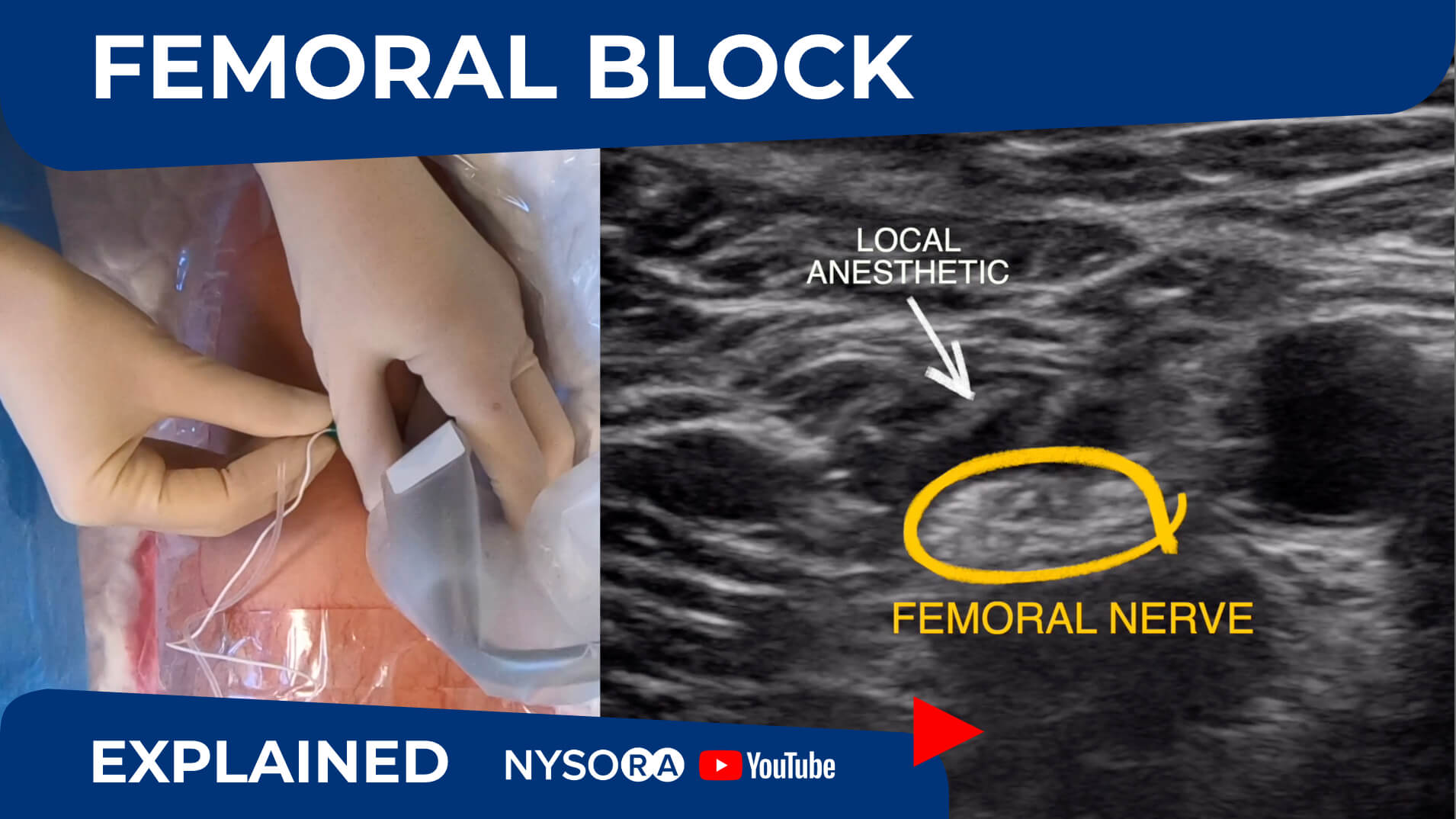 Ultrasound-guided single popliteal sciatic nerve block for ...