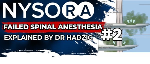 Crash Course: Failed Spinal Anesthesia Explained #2 - NYSORA