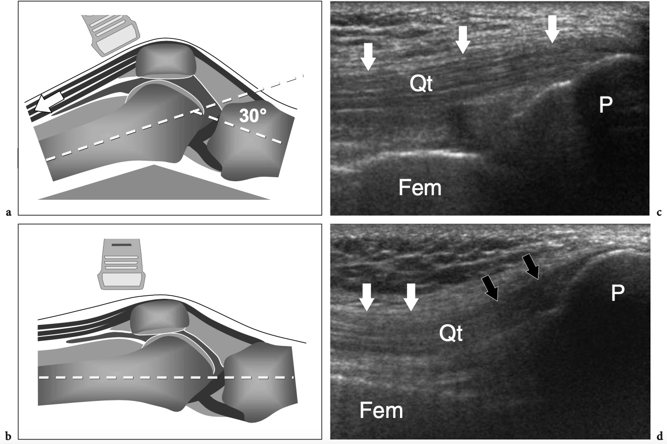 ultrasound-of-the-musculoskeletal-system-knee-2 - NYSORA