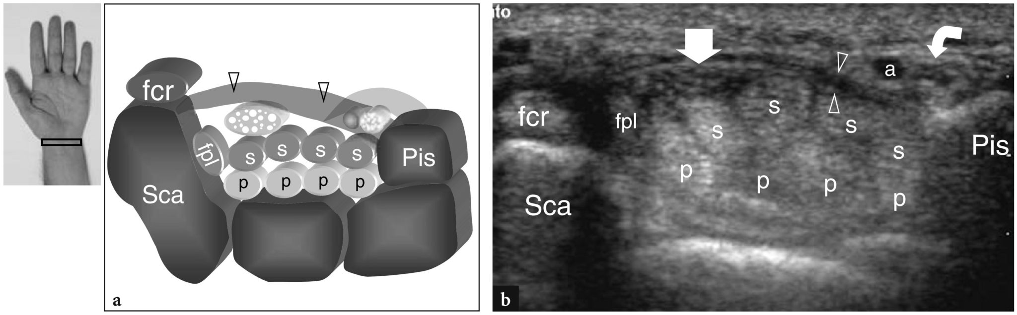 Ultrasound of the Musculoskeletal System - Chapter #10: Wrist - NYSORA