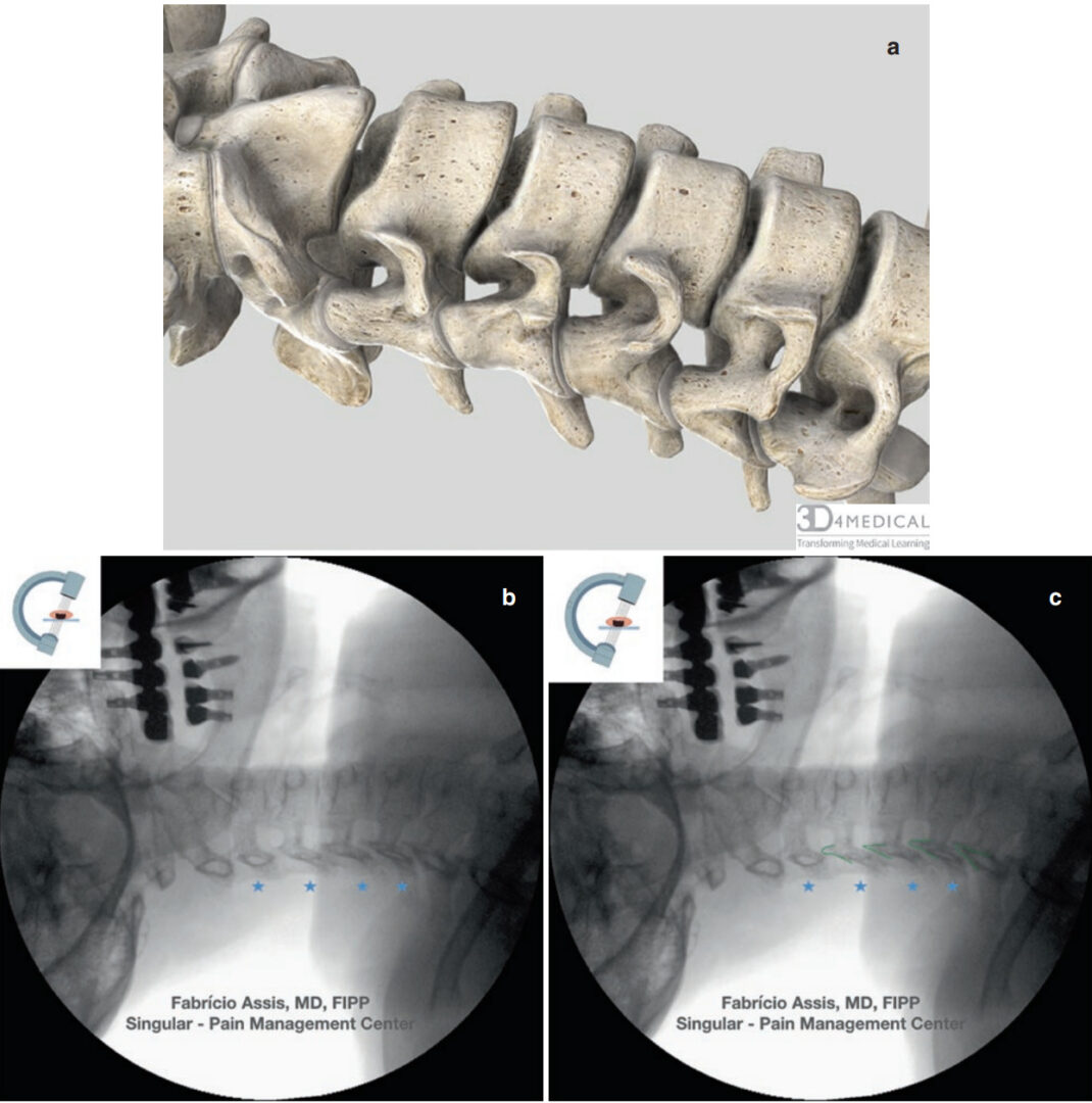 Cervical Medial Branch Block and Radiofrequency Ablation – Oblique ...