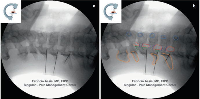 Cervical Medial Branch Block and Radiofrequency Ablation – Oblique ...