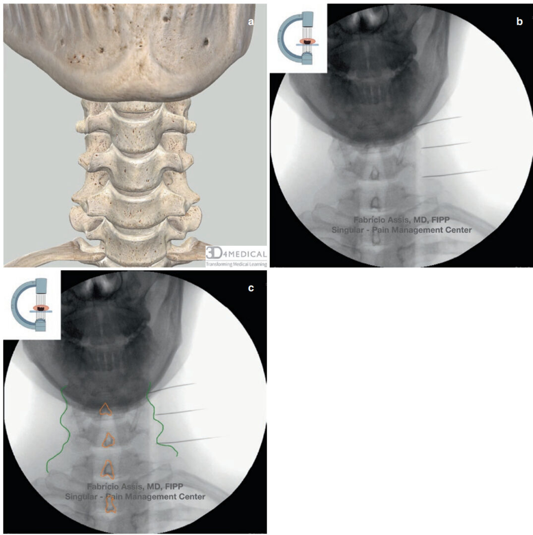 Cervical Medial Branch Block and Radiofrequency Ablation – Oblique ... Cervical Medial Branch Block and Radiofrequency Ablation – Oblique ...