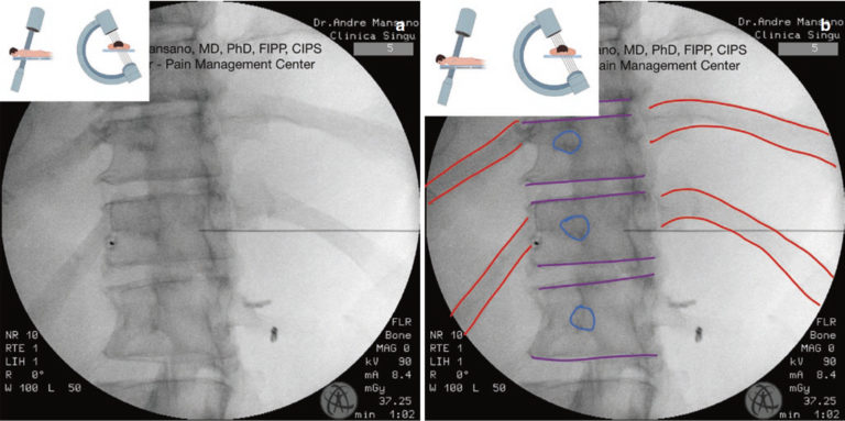Splanchnic Block and Radiofrequency Ablation - NYSORA