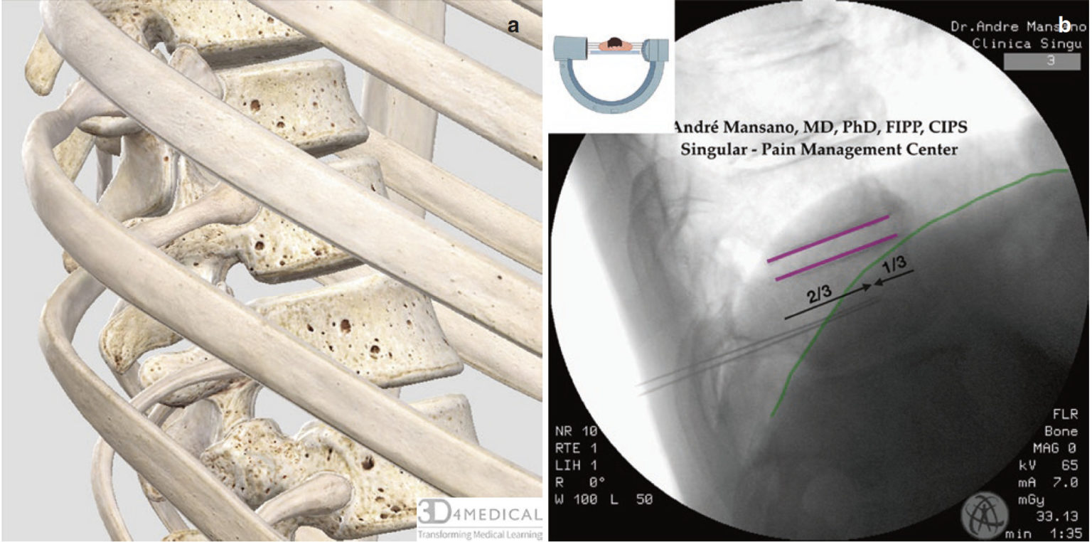 Splanchnic Block and Radiofrequency Ablation - NYSORA