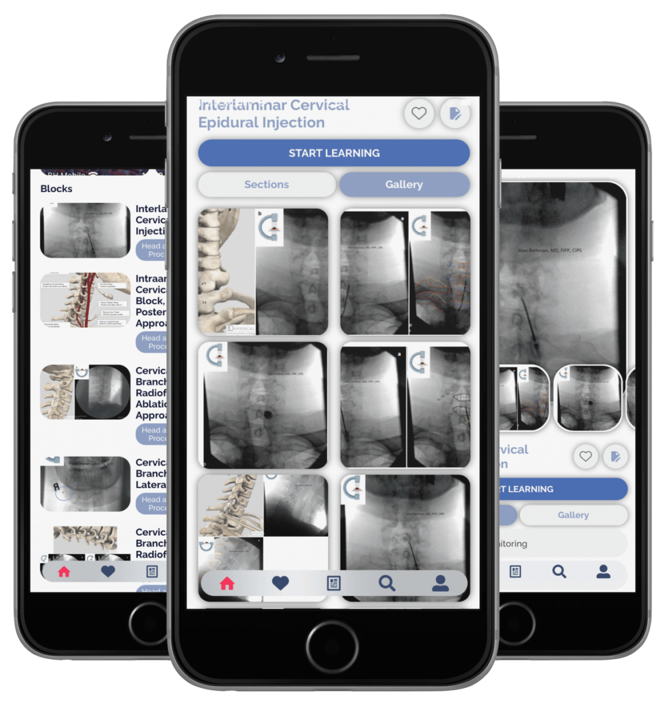 Interventional Pain App - Fluoroscopy Guided Injection