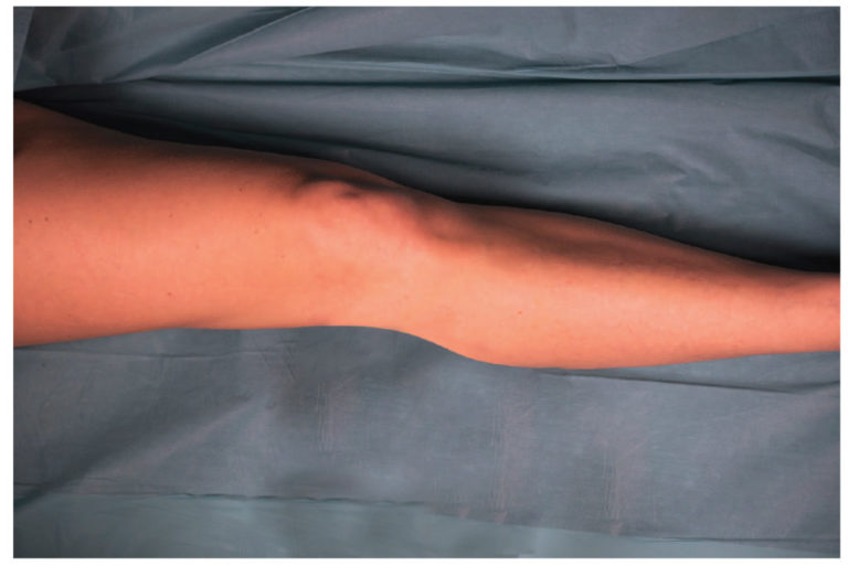 Genicular Nerve Blocks - NYSORA