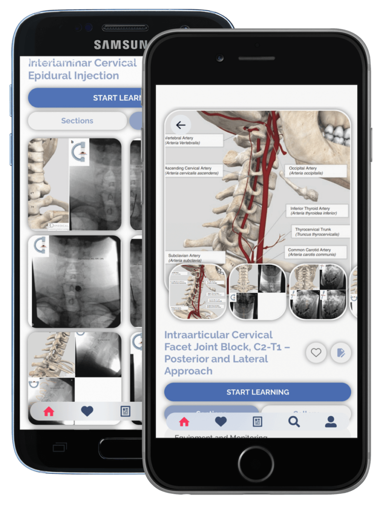 Interventional Pain App - Fluoroscopy Guided Injection
