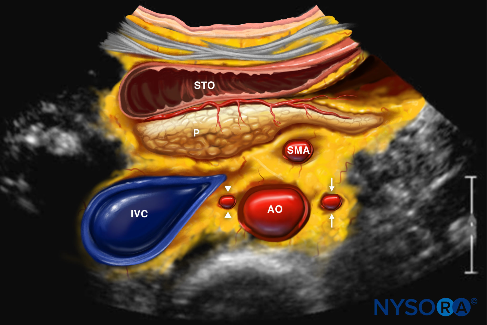 Ultrasound-Guided Celiac Plexus Block and Neurolysis - NYSORA