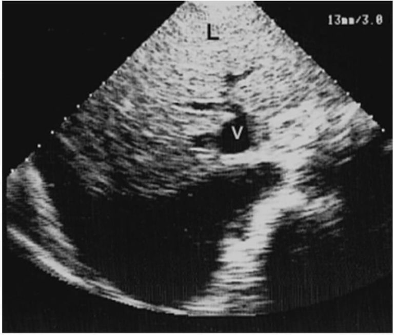 PLAPS and Pleural Effusion - NYSORA