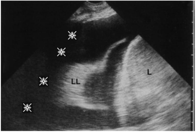 PLAPS e Derrame Pleural - NYSORA