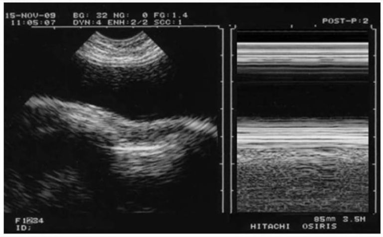 PLAPS and Pleural Effusion - NYSORA