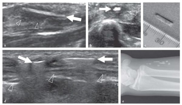 Skin and Subcutaneous Tissue - NYSORA