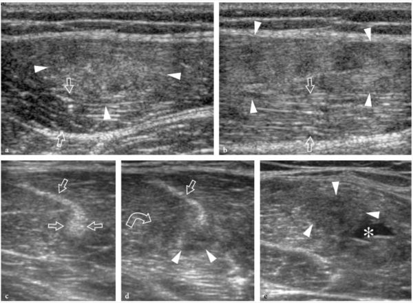 Muscle and Tendon - NYSORA