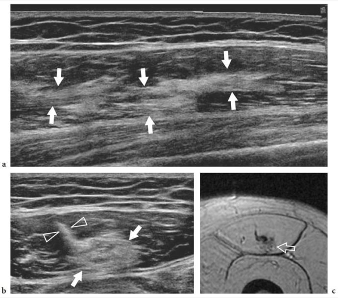 Muscle and Tendon - NYSORA