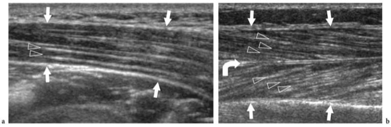 Músculo y tendón - NYSORA