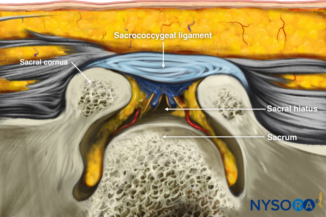 Bloques neuroaxiales centrales guiados por ultrasonido - NYSORA