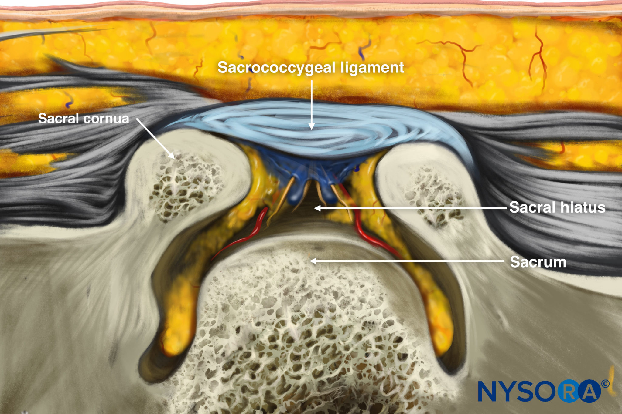 Ultrasound-Guided Central Neuraxial Blocks - NYSORA